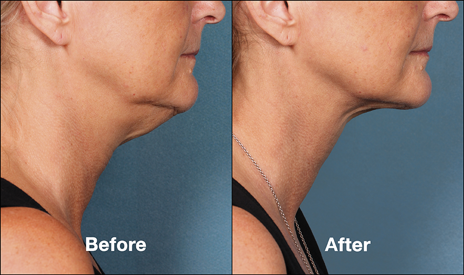 The Double Chin’s Days are Numbered – Two new treatments available ...