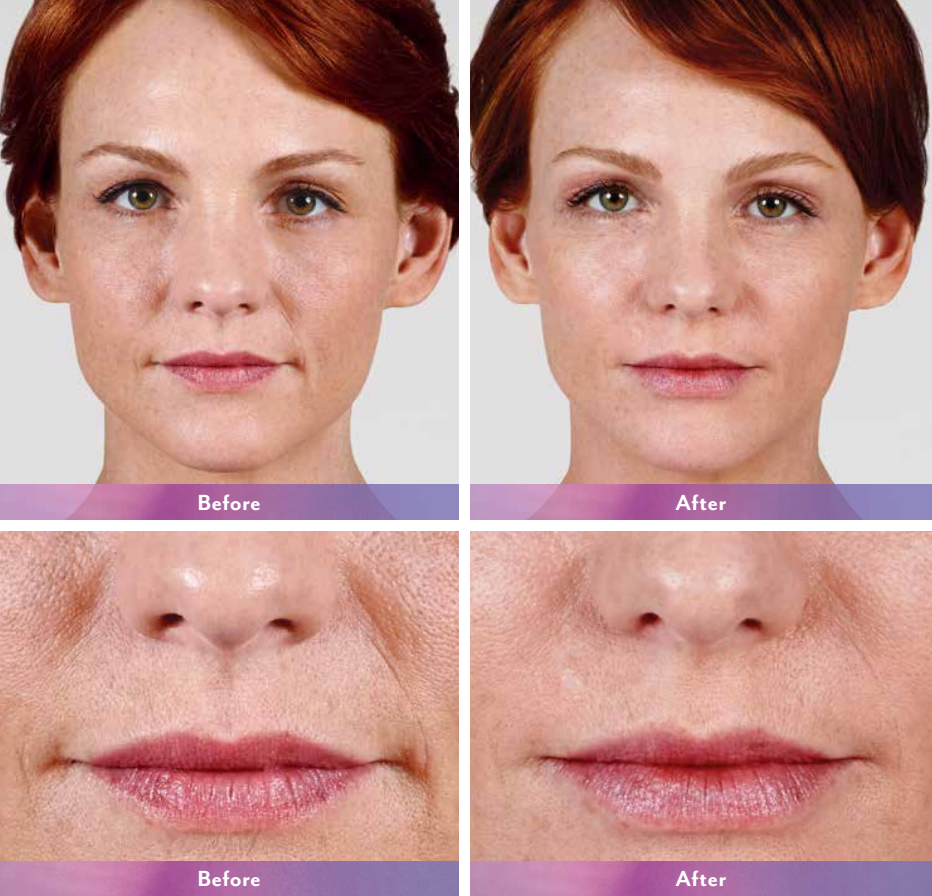 Youthful, Natural-looking Lips Through The Ages - Humphrey Dermatology